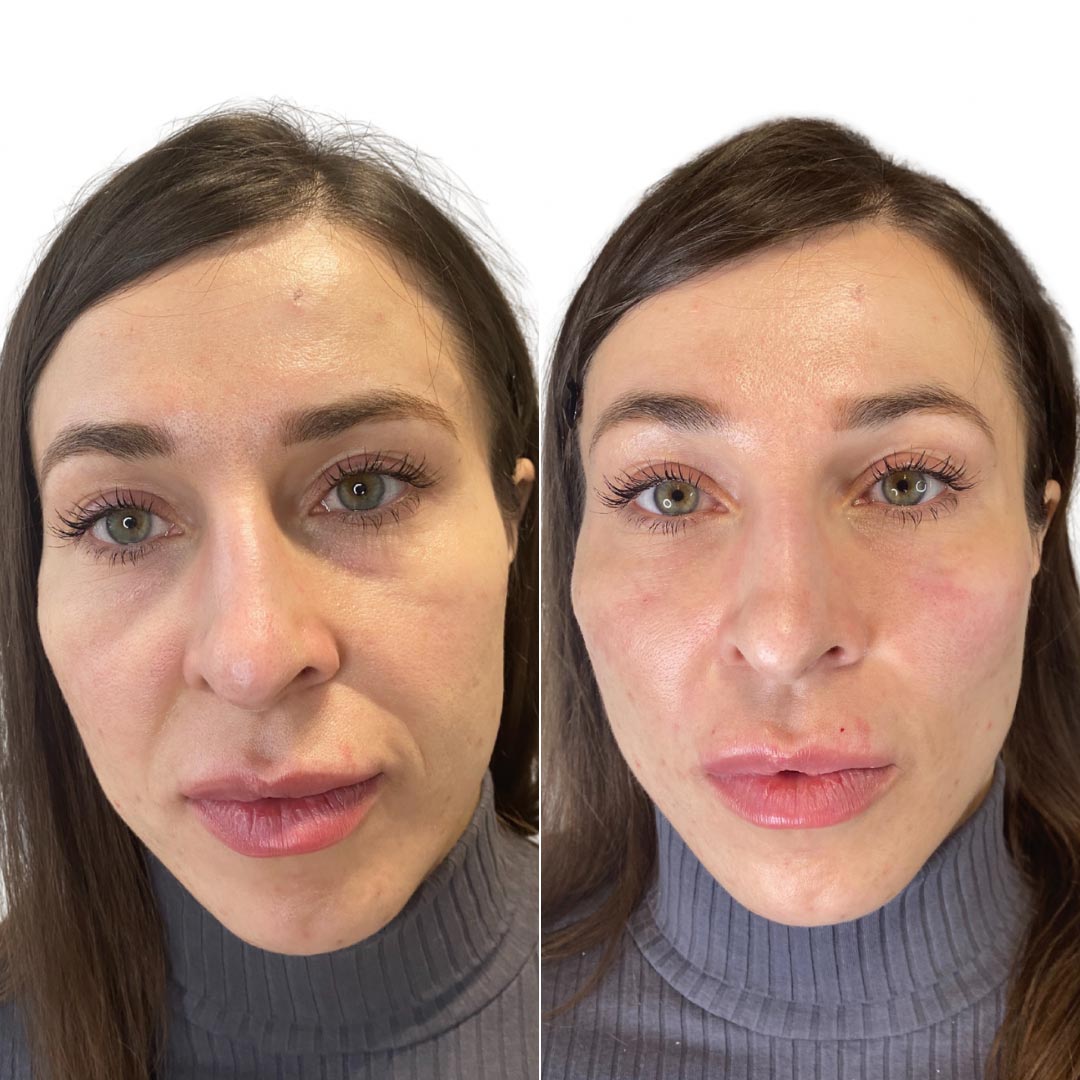 Cheek Volume Injections | SAS Aesthetics