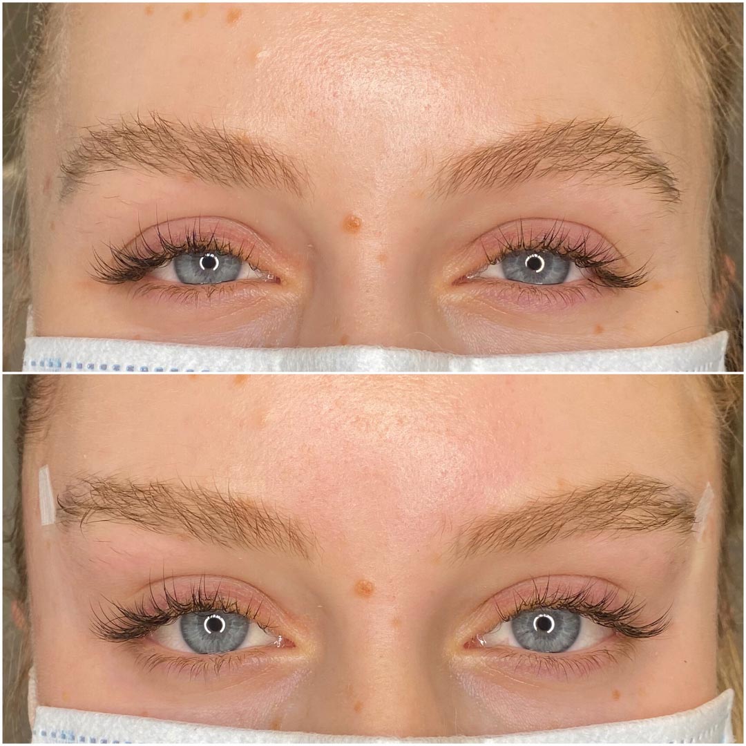 Non-surgical Eye Brow Lift London | SAS Aesthetics