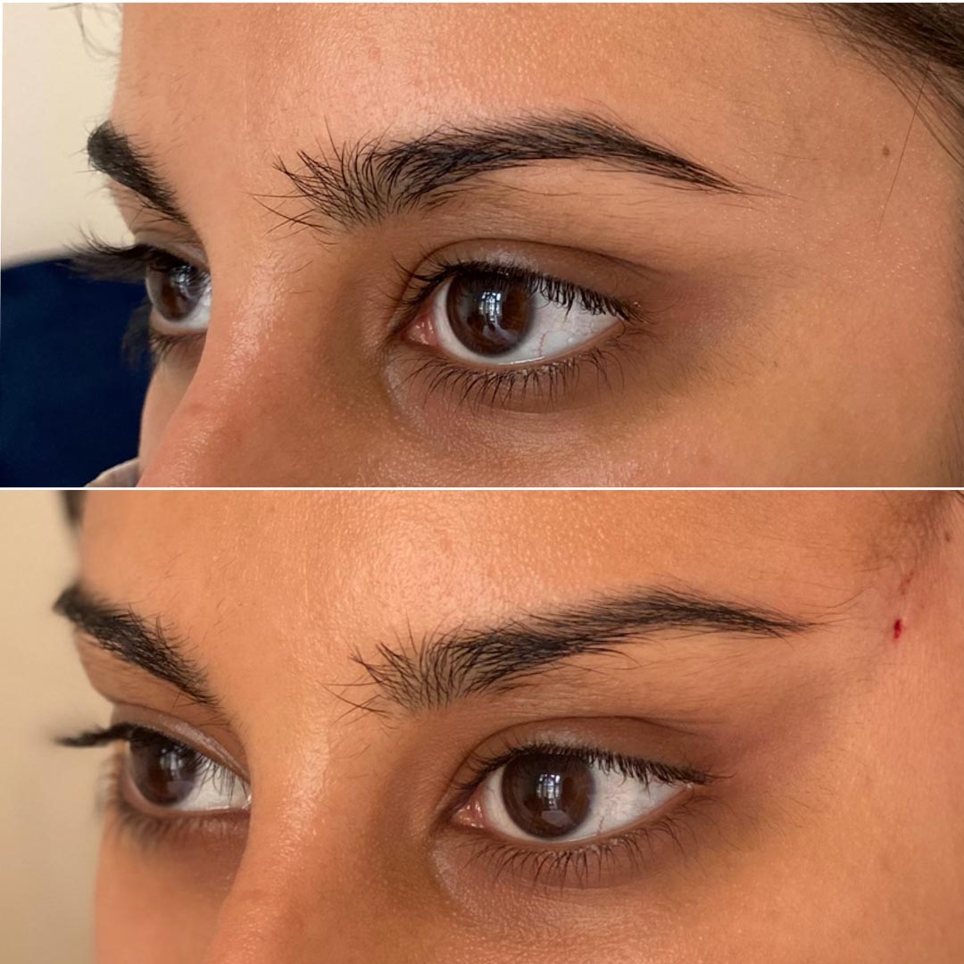 Non-surgical Eye Brow Lift London | SAS Aesthetics