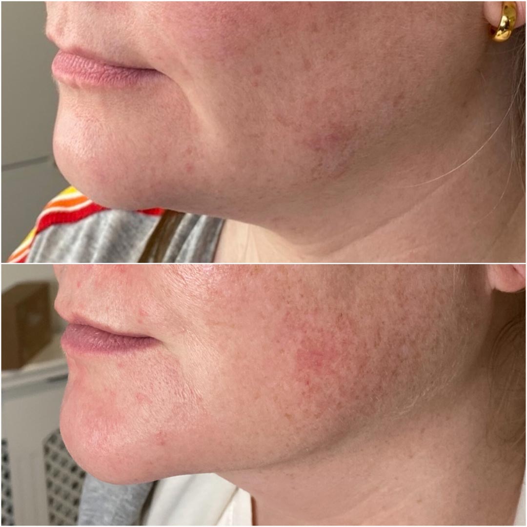 Fat Dissolving Injections London | SAS Aesthetics