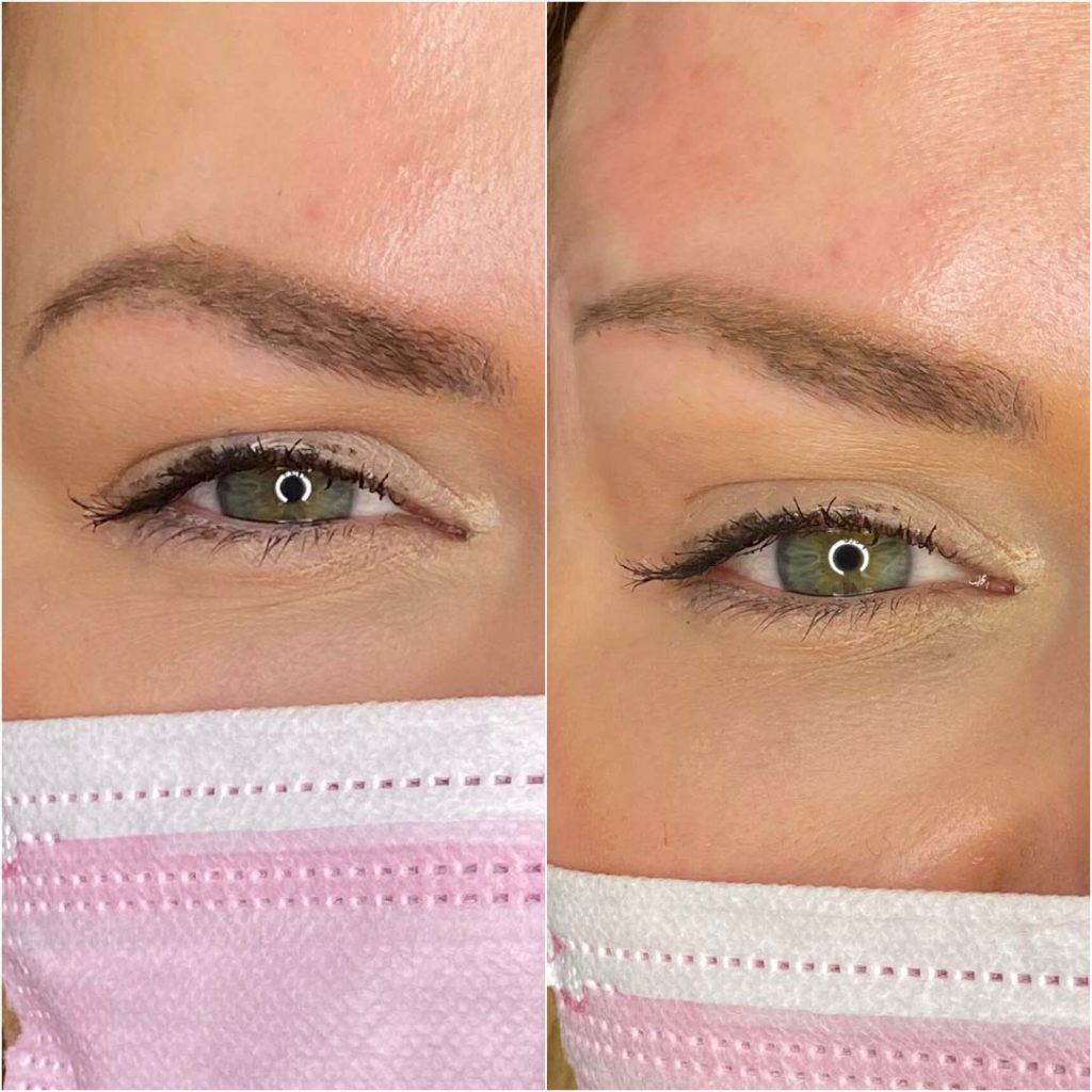 Fox Eye Thread Lift London | SAS Aesthetics