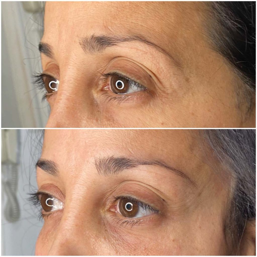 Fox Eye Thread Lift London | SAS Aesthetics