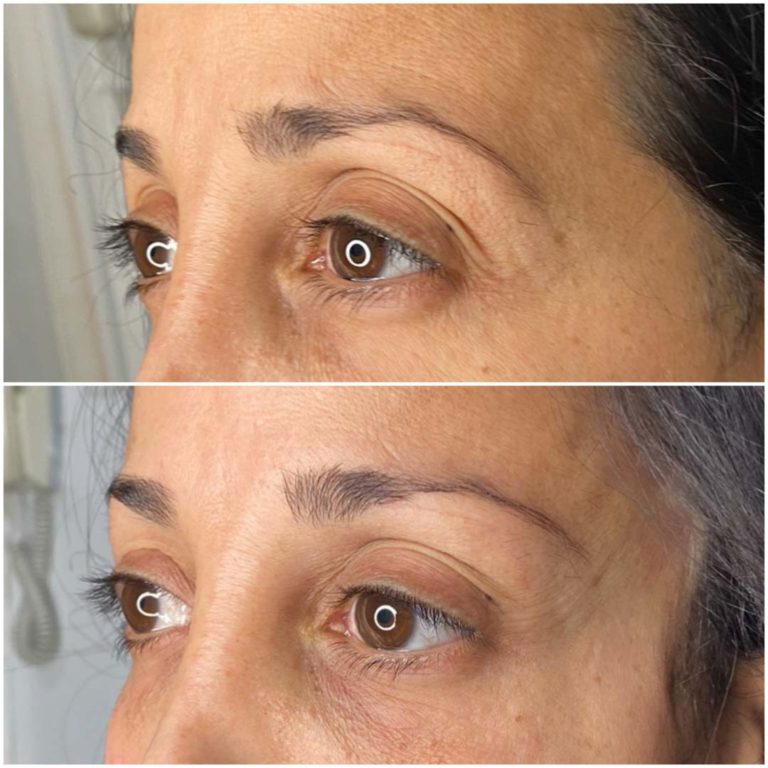 Fox Eye Thread Lift London | SAS Aesthetics