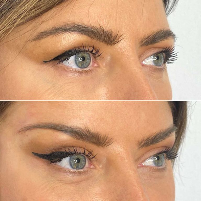 Fox Eye Thread Lift London | SAS Aesthetics
