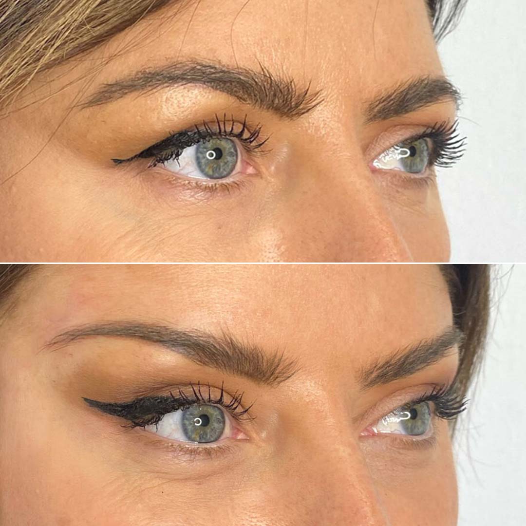 Fox Eye Thread Lift London | SAS Aesthetics