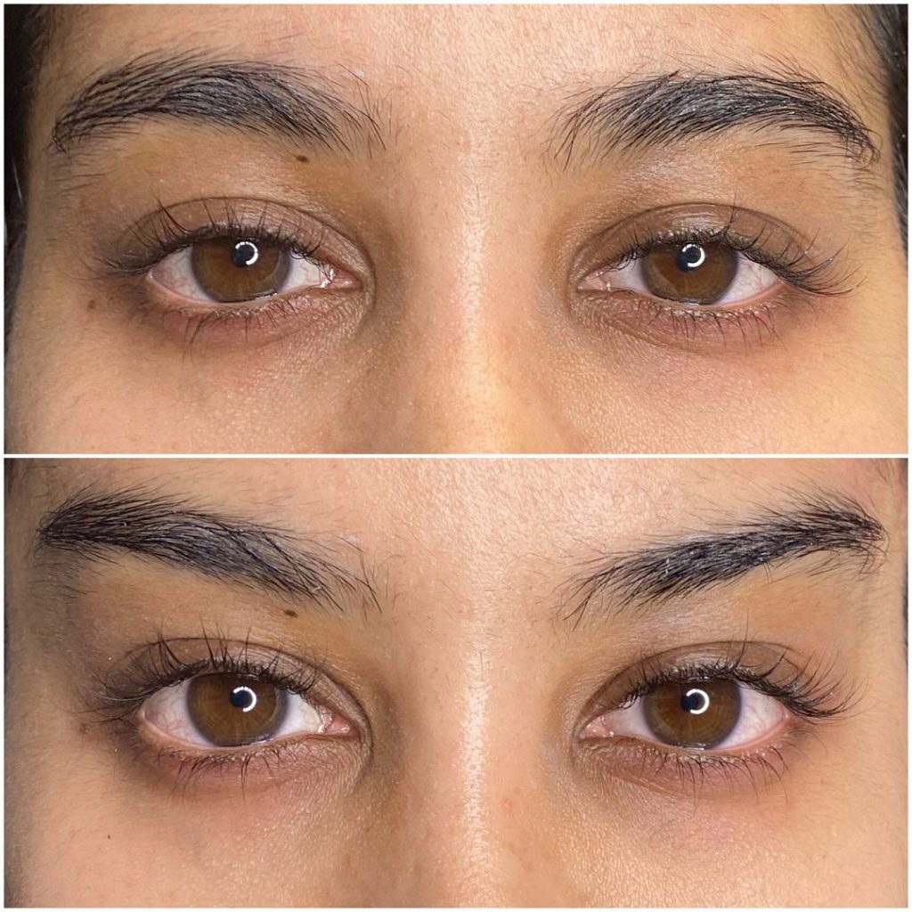 Fox Eye Thread Lift London | SAS Aesthetics