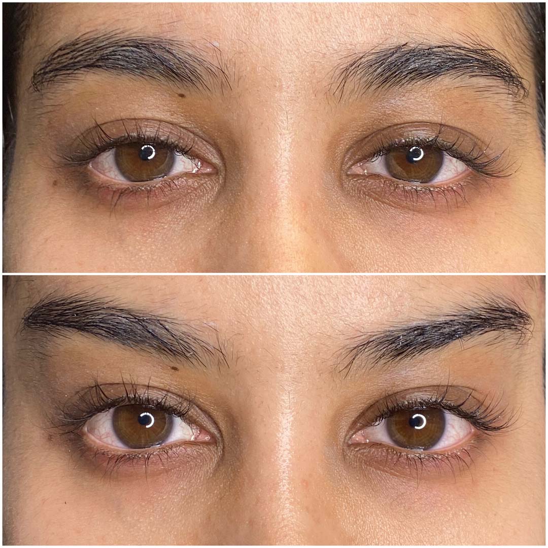 Fox Eye Thread Lift London | SAS Aesthetics