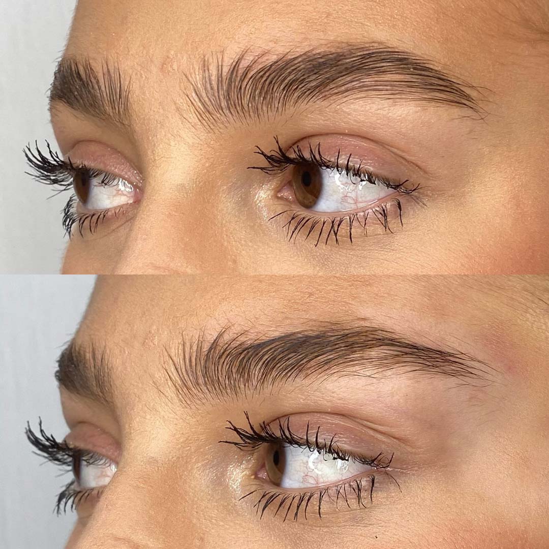 Fox Eye Thread Lift London | SAS Aesthetics