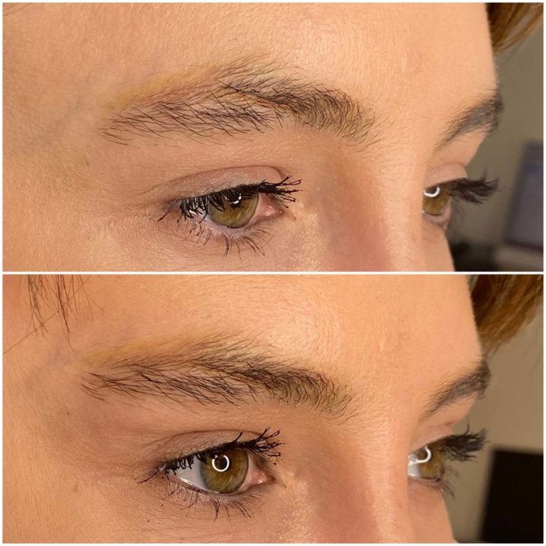 Fox Eye Thread Lift London | SAS Aesthetics