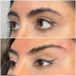 Fox Eyes Thread Lift London | Fox Eyes Thread Lift Chelsea