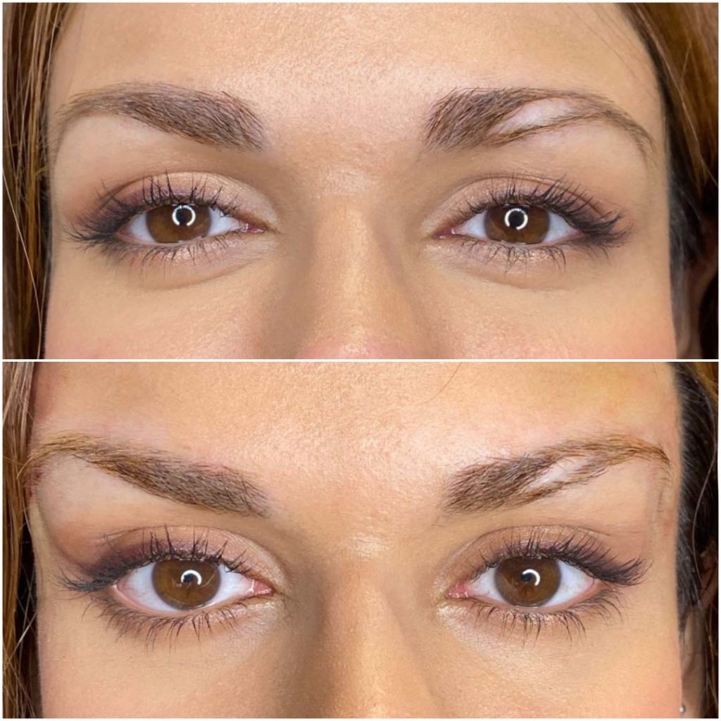 Fox Eye Thread Lift London | SAS Aesthetics