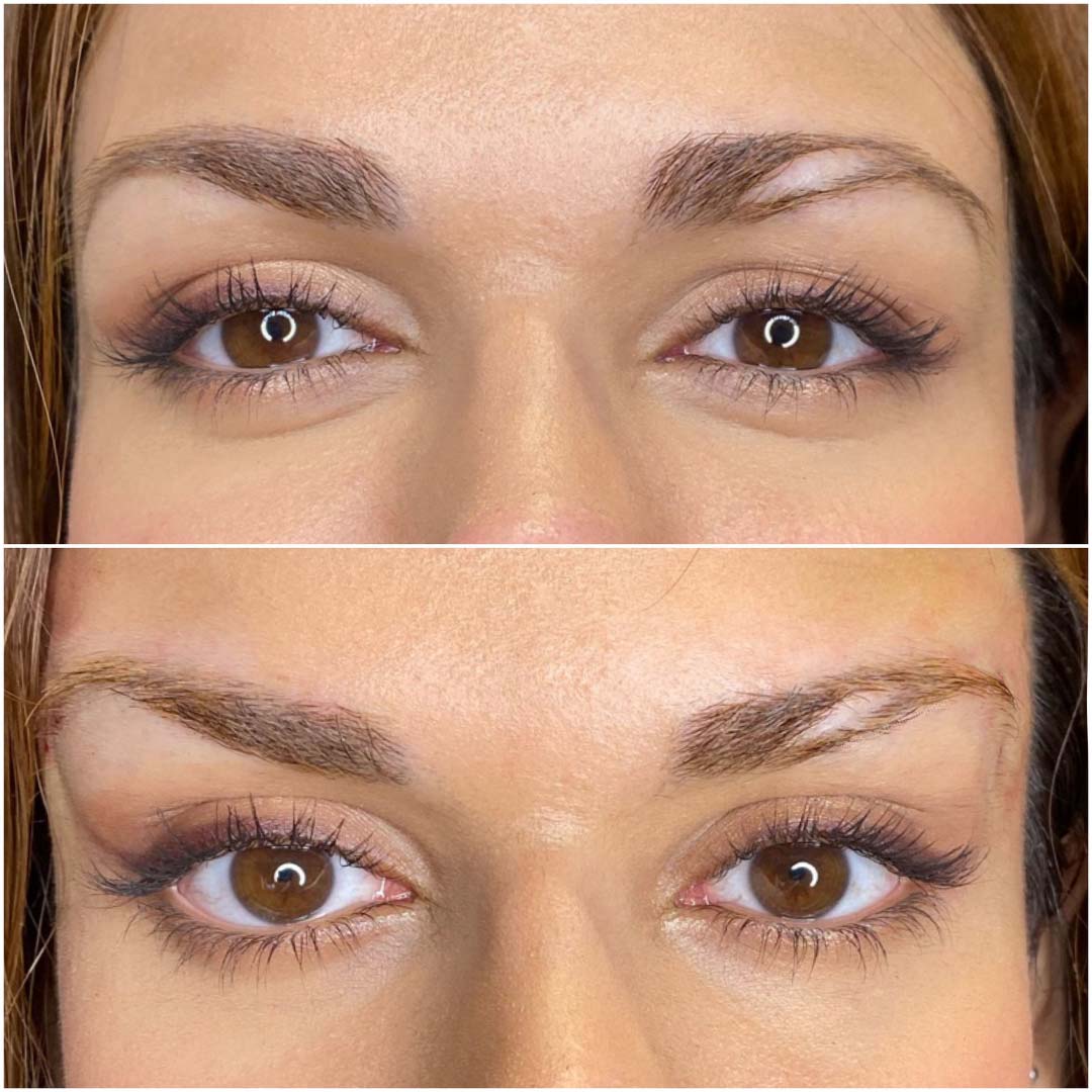 Fox Eye Thread Lift London | SAS Aesthetics