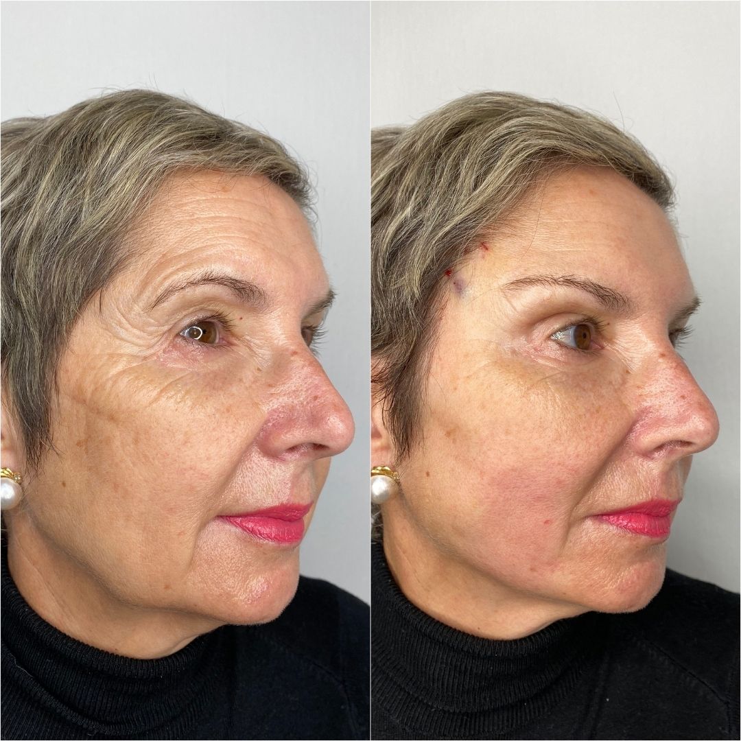 Fox Eye Thread Lift London | SAS Aesthetics