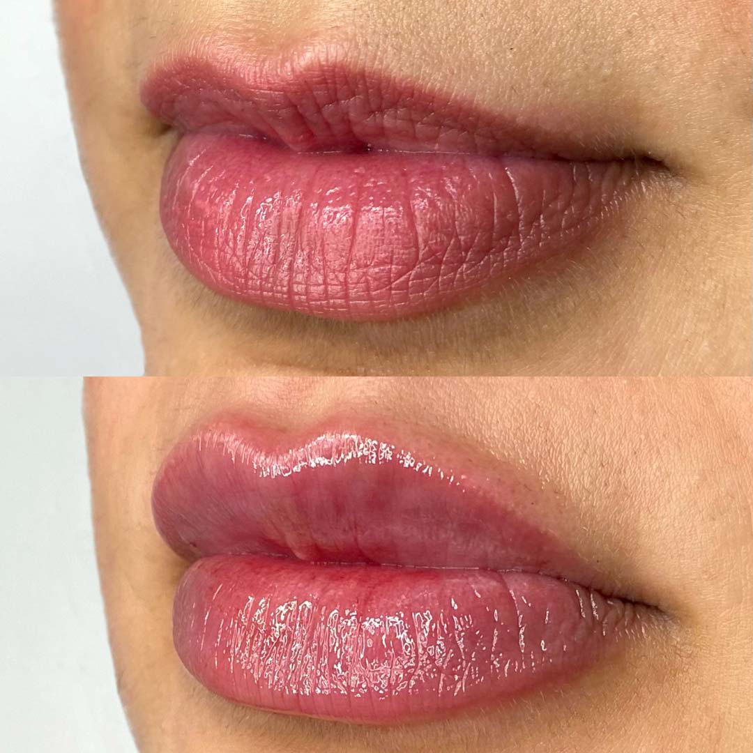 Lip Filler Augmentation Injections London | SAS Aesthetics