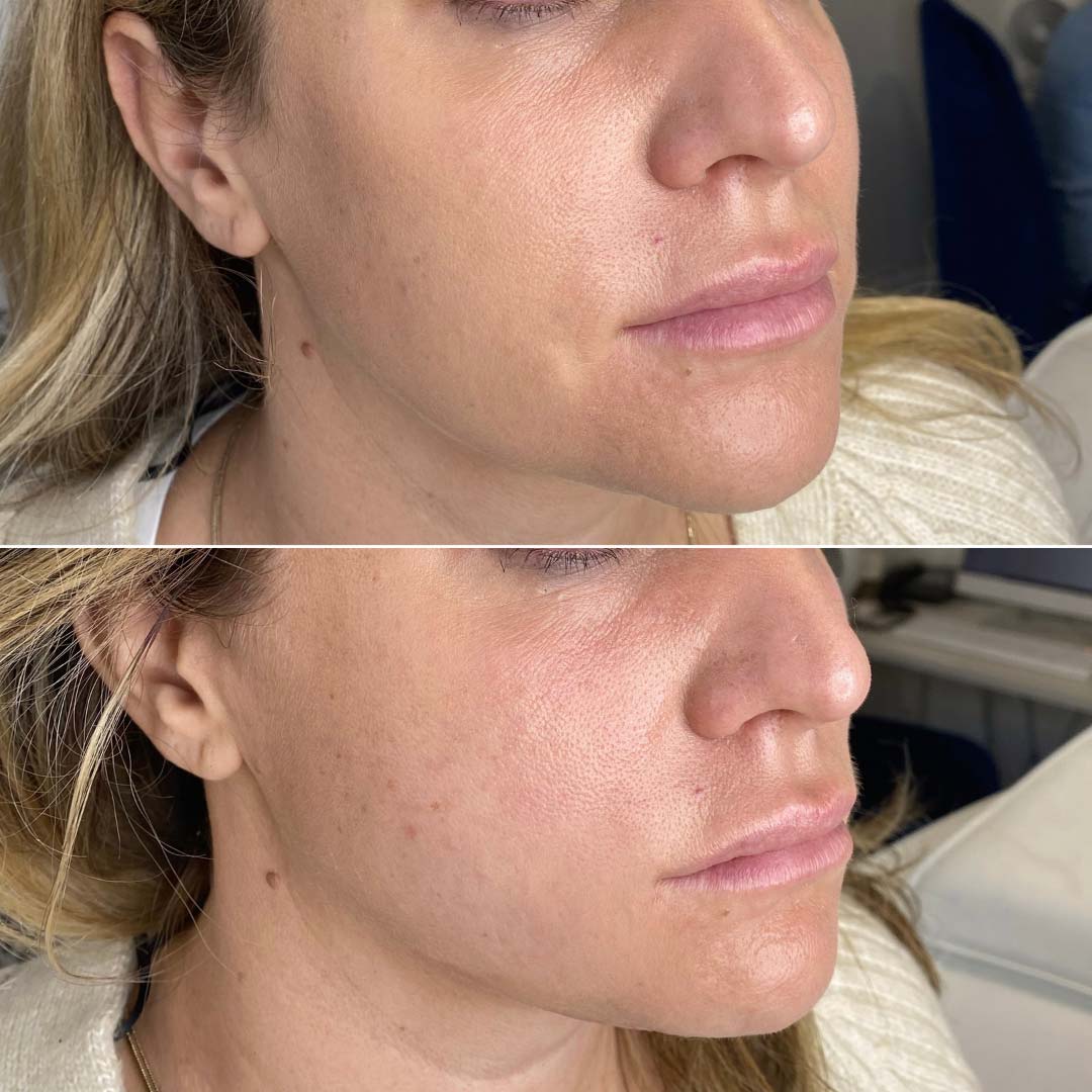 Lower Face Thread Lift London | SAS Aesthetics