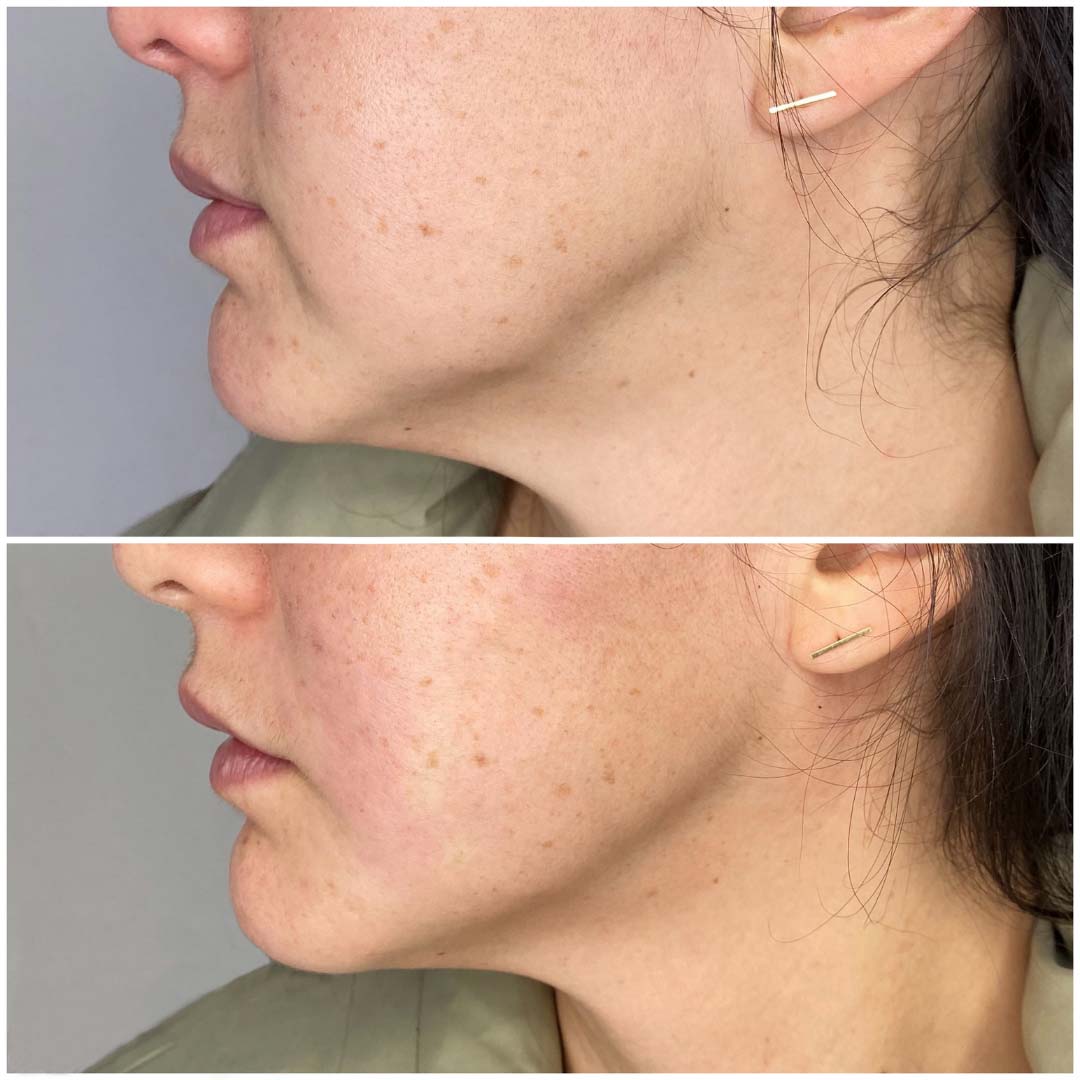 Lower Face Thread Lift London | SAS Aesthetics