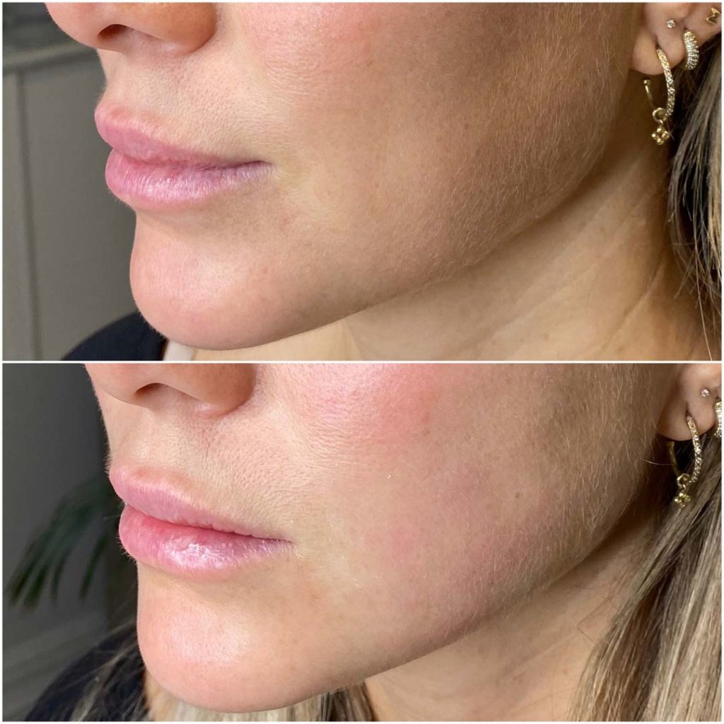Lower Face Thread Lift London | SAS Aesthetics