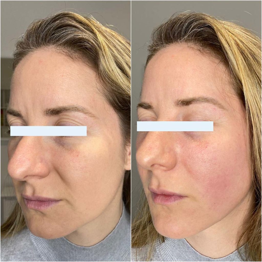 Lower Face Thread Lift London | SAS Aesthetics