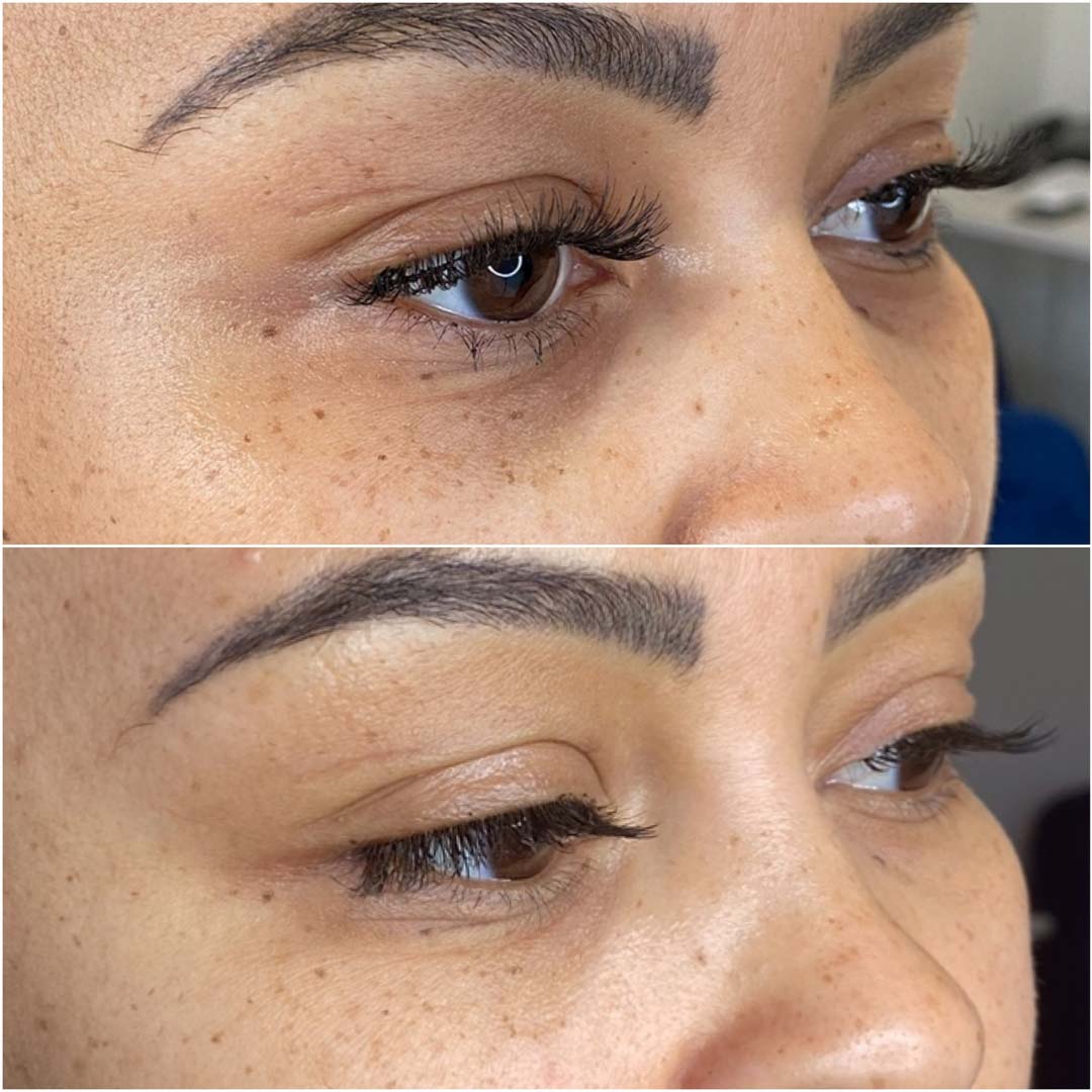 Mesotherapy Skin Brightening Injections London | SAS Aesthetics
