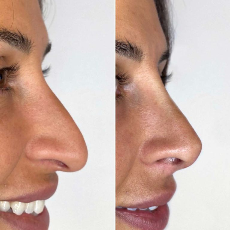 Nose Thread Lift London | SAS Aesthetics