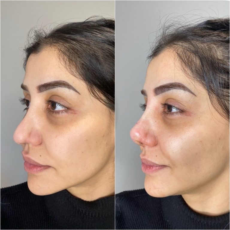 Nose Thread Lift London | SAS Aesthetics
