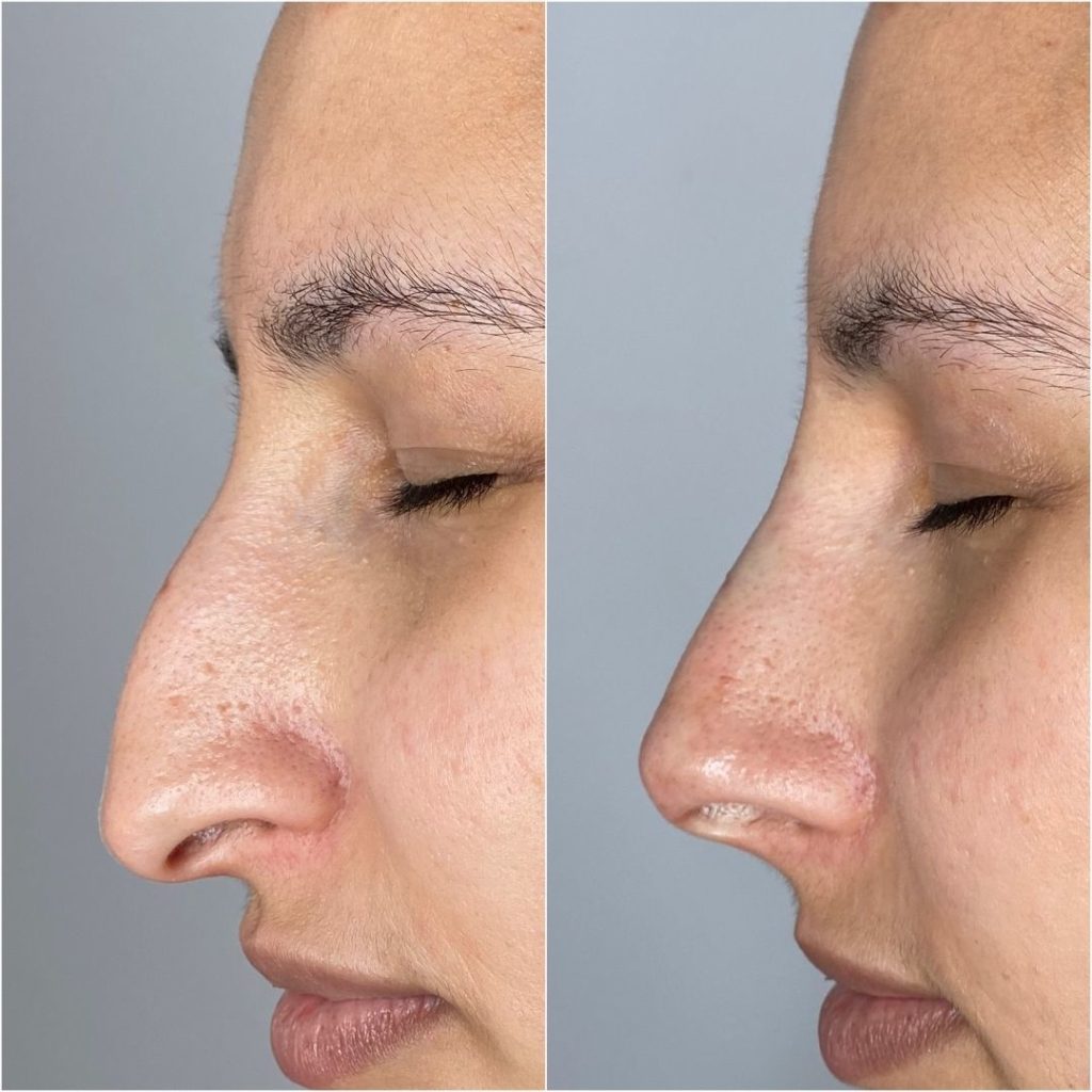 Nose Thread Lift London | SAS Aesthetics
