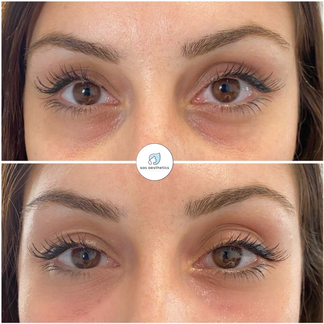 Tear Trough Injections London | SAS Aesthetics