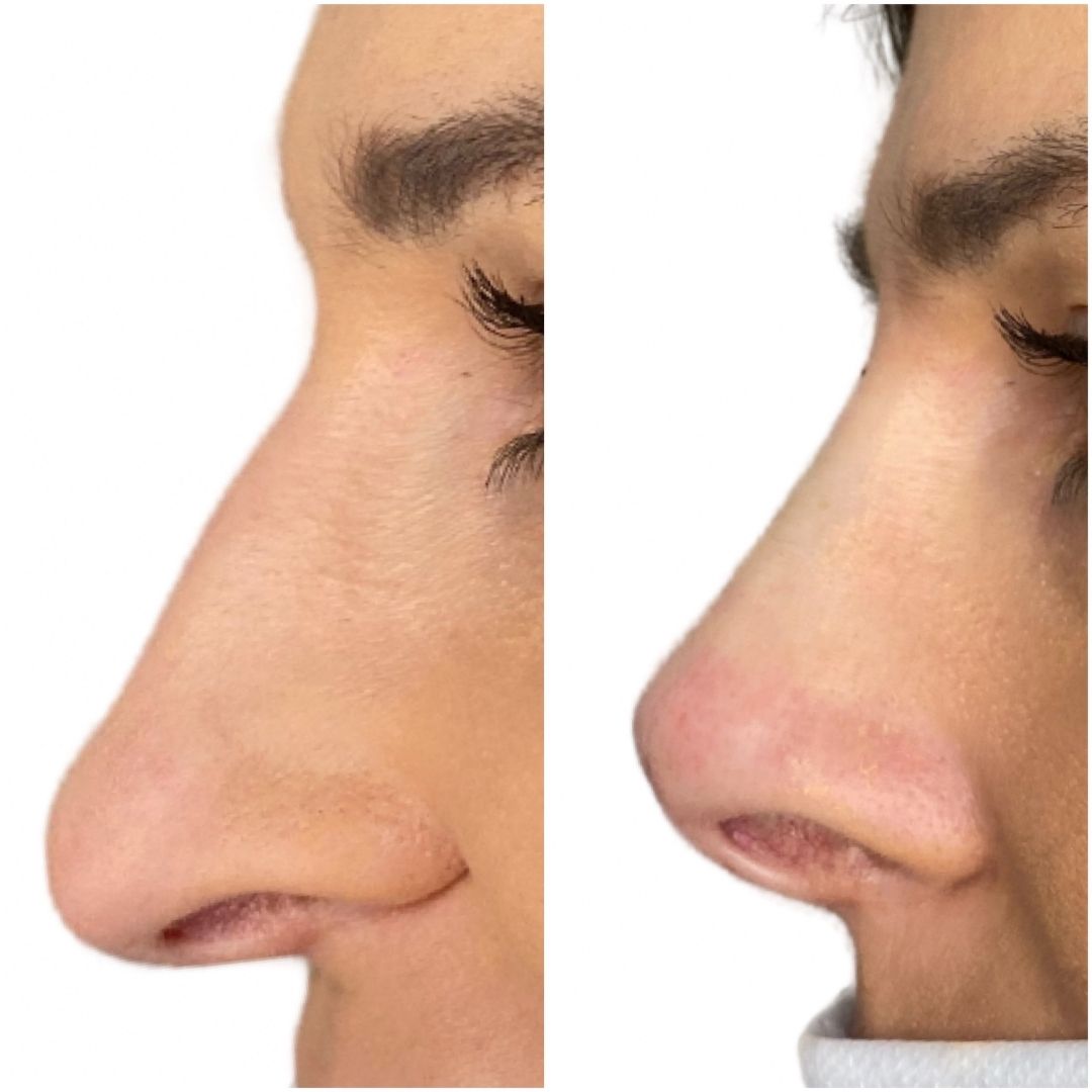 Nose Thread Lift London | SAS Aesthetics | Nose Threads Mayfair