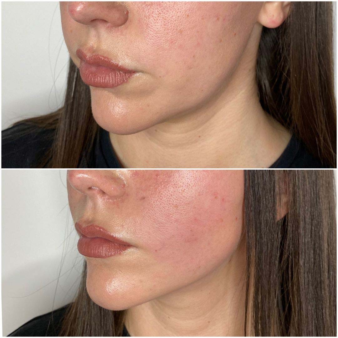 Lower Face Thread Lift London | SAS Aesthetics