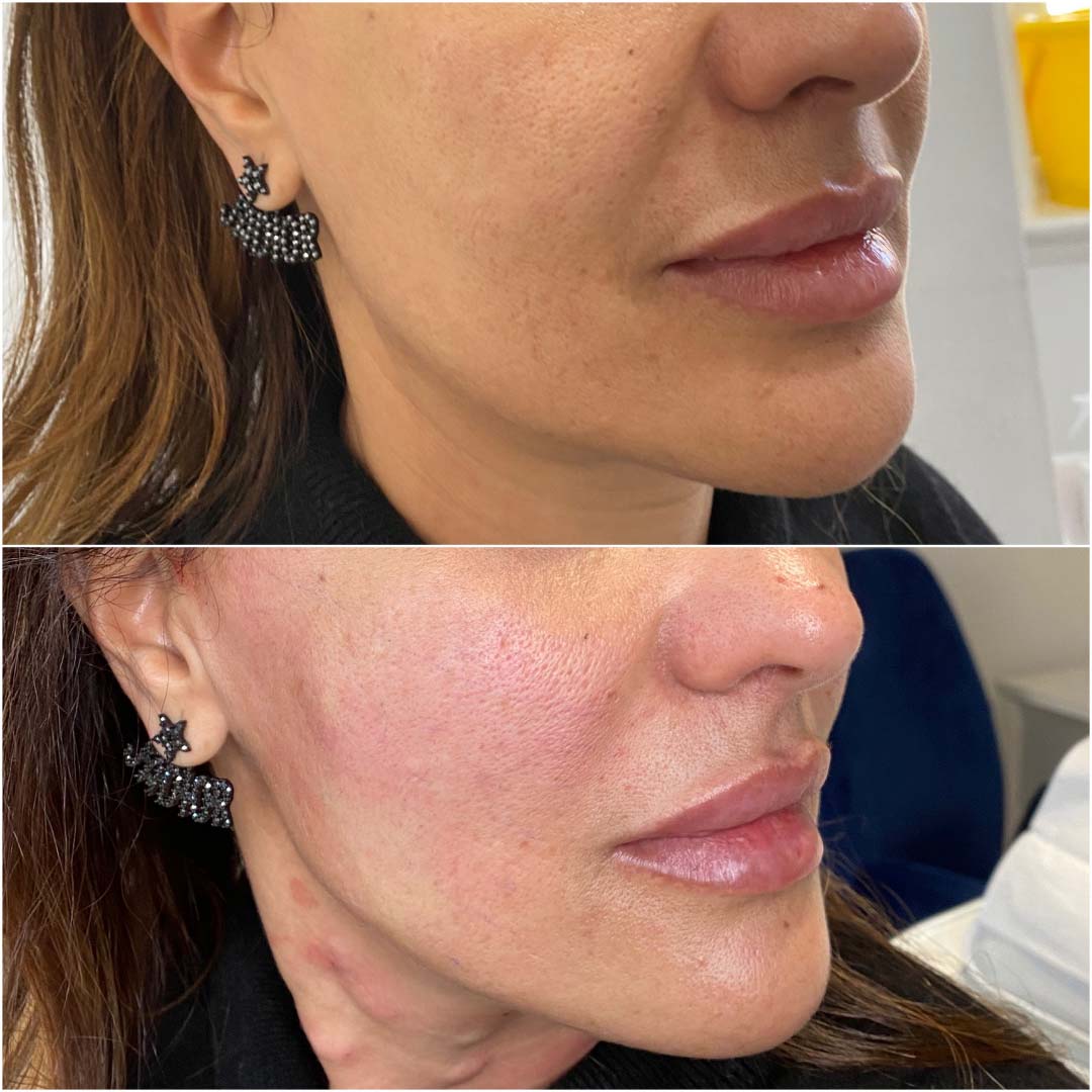 Lower Face Thread Lift London | SAS Aesthetics