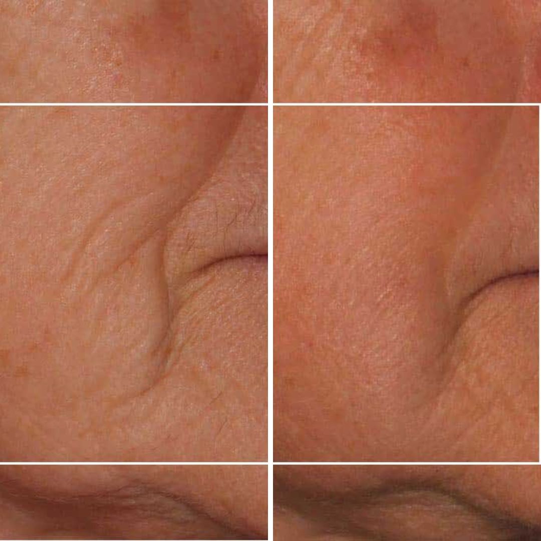 Sofwave Skin Tightening Treatment London | SAS Aesthetics