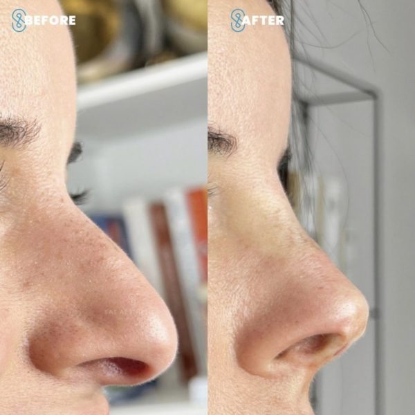 Non-Surgical Rhinoplasty London | SAS Aesthetics